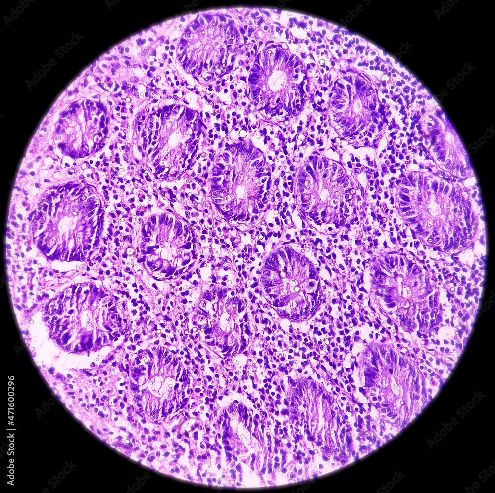 Appendix, Acute appendicitis, show vermiform appendix wall ...