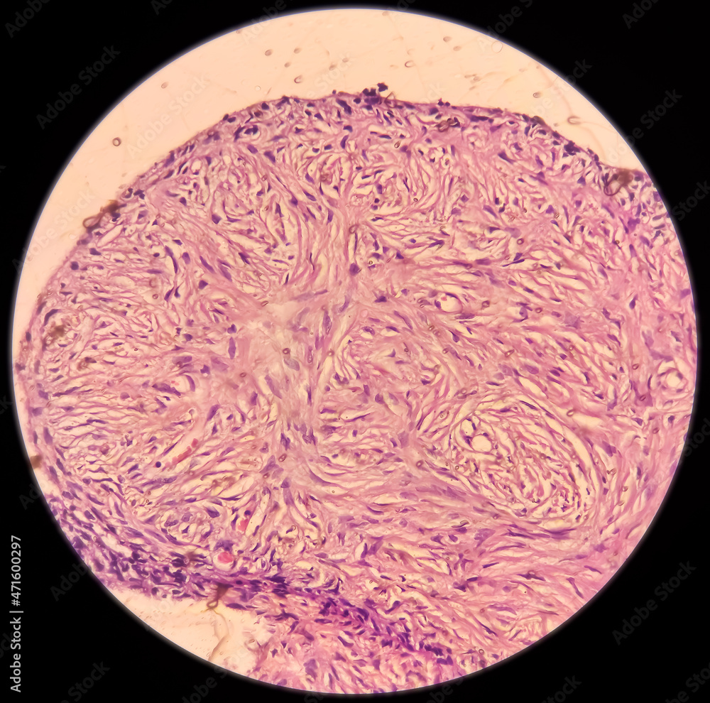 Ovarian cyst, Serous cystadenofibroma, relatively rare benign ovarian ...