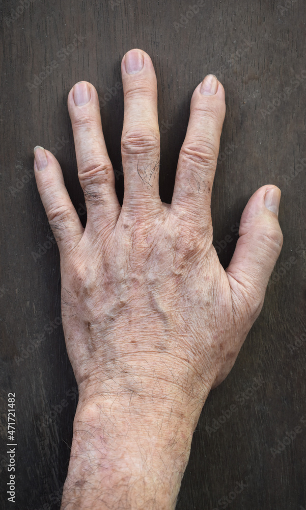 Age spots on hand. They are brown, gray, or black spots and also called ...