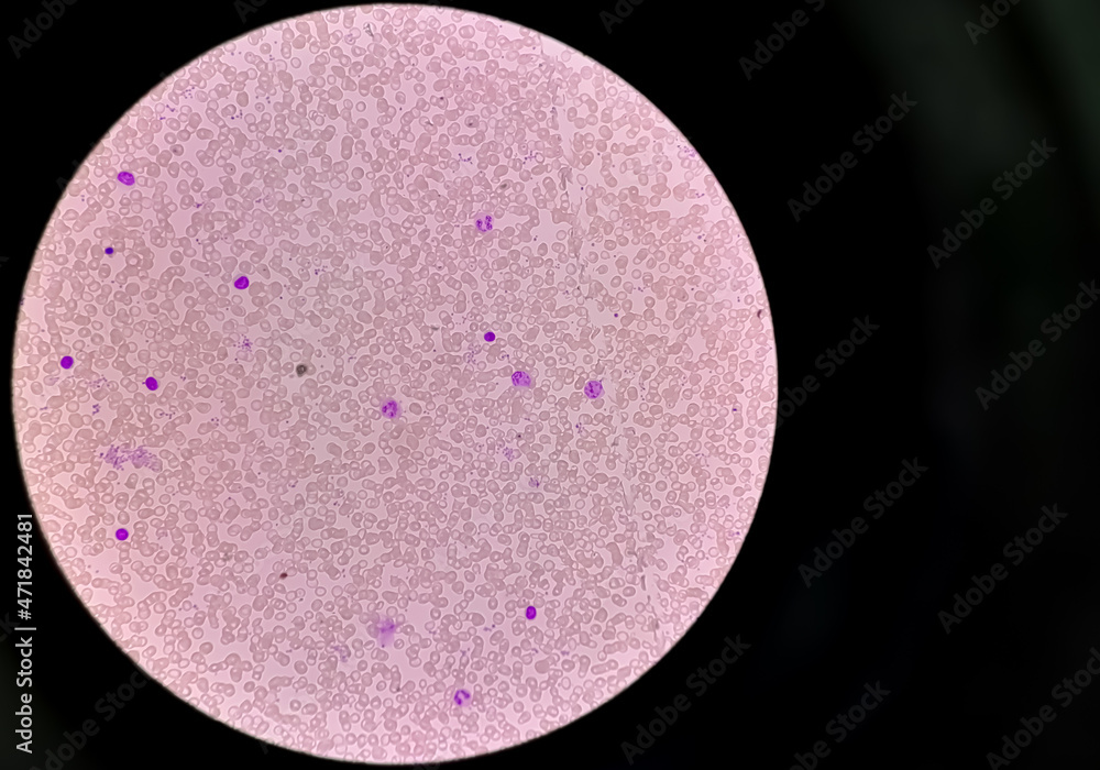 Abnormal microscopic view of hematological slide. Hemoglobin E (HbE ...