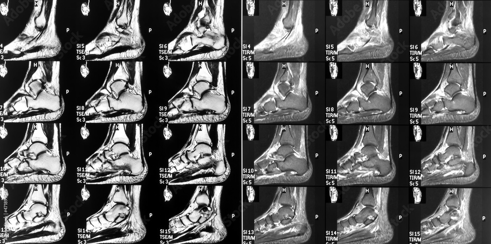 MRI Magnetic Resonance scan image of the left foot and ankle Stock ...