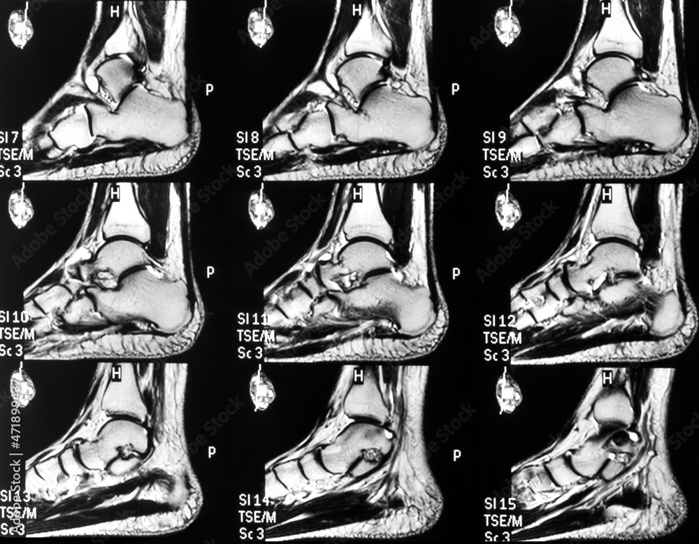 MRI Magnetic Resonance scan image of the left foot and ankle Stock ...