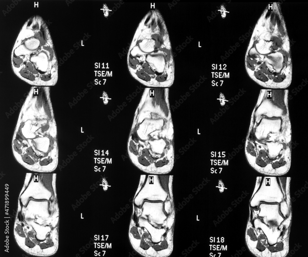 MRI Magnetic Resonance scan image of the left foot and ankle Stock ...