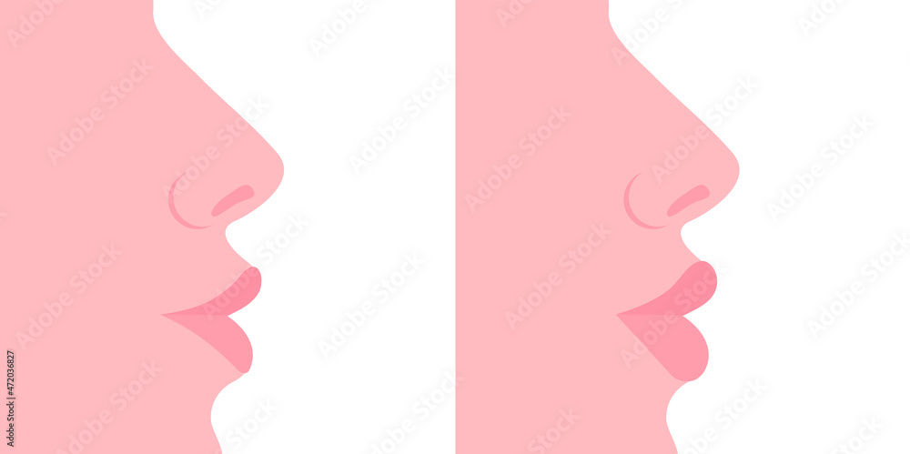 Female profile. Thin lips, plump lips. Plastic surgery, lip ...