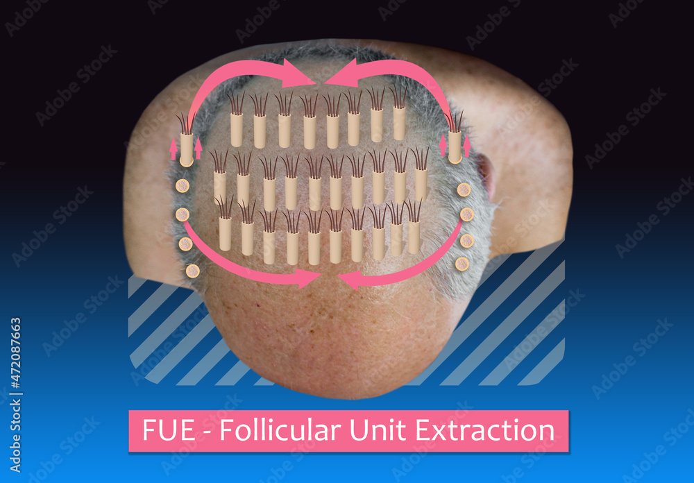 Methods of hair transplantation fut vs fue with infographic elements of ...