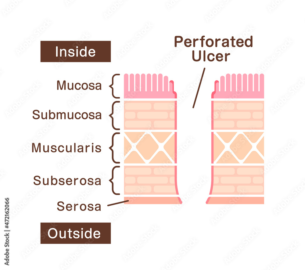 Sectional view illustration of perforated ulcer Stock Vector | Adobe Stock
