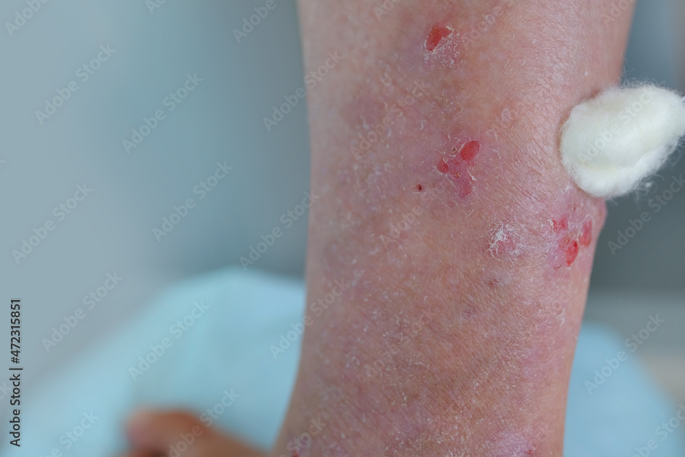 female doctor assistant examines and treats leg woman with scratches ...