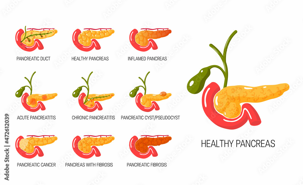 Pancreas diseases concept in flat style, vector Stock Vector | Adobe Stock