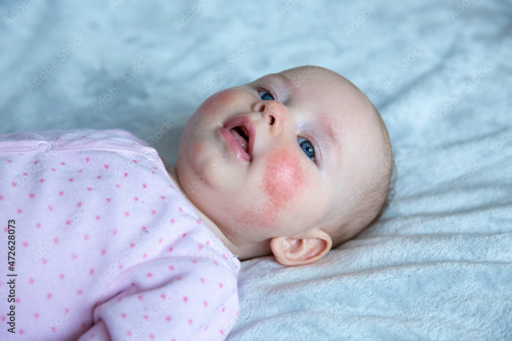 Newborn baby girl with red skin rash, dermatitics syndrom Stock Photo ...
