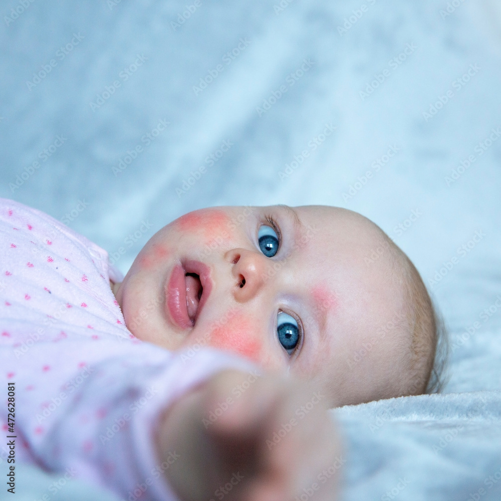Little girl face with many red pimples on the face. Stock Photo | Adobe ...