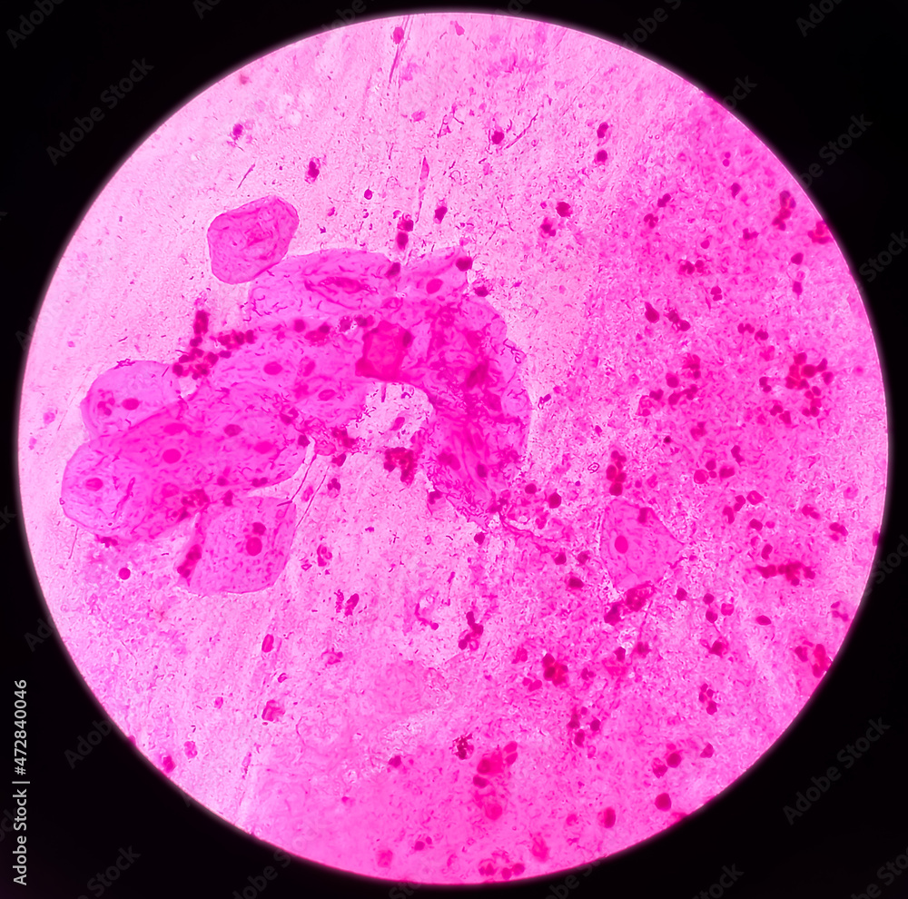 Gram stain microscopic slide, plenty epithelial cells, few pus cells ...