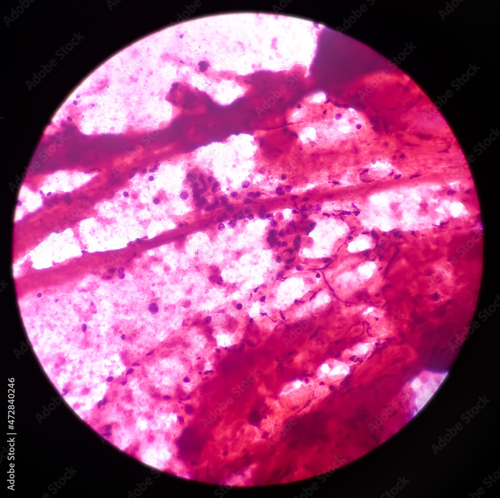 Inguinal lymph node, Malignant small round cell tumor, metastatic ...