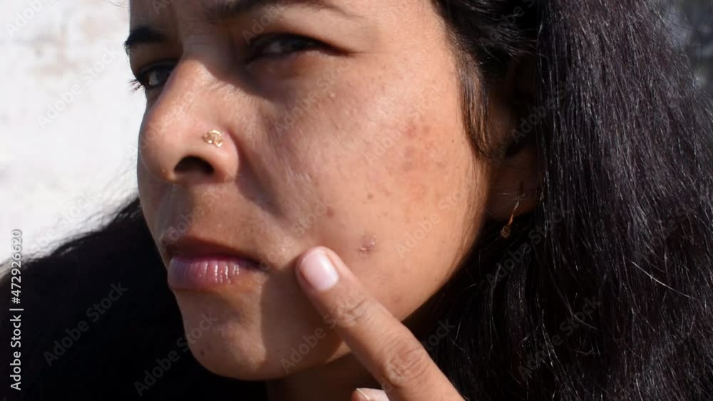 Young Indian Woman face skin problem acne, acne marks, rough ,dull and ...