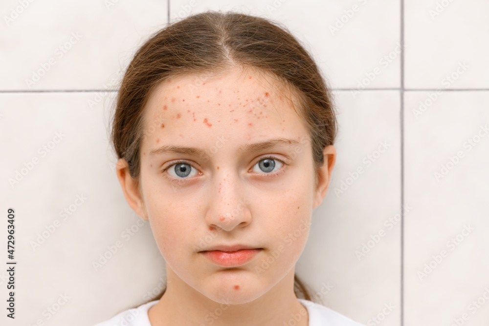 face of a teenage girl with pimples, acne on the skin, portrait of ...
