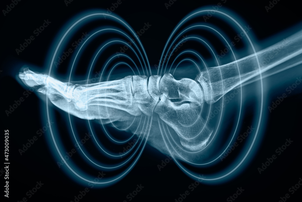 Foot pain on x-ray on black background Stock Photo | Adobe Stock