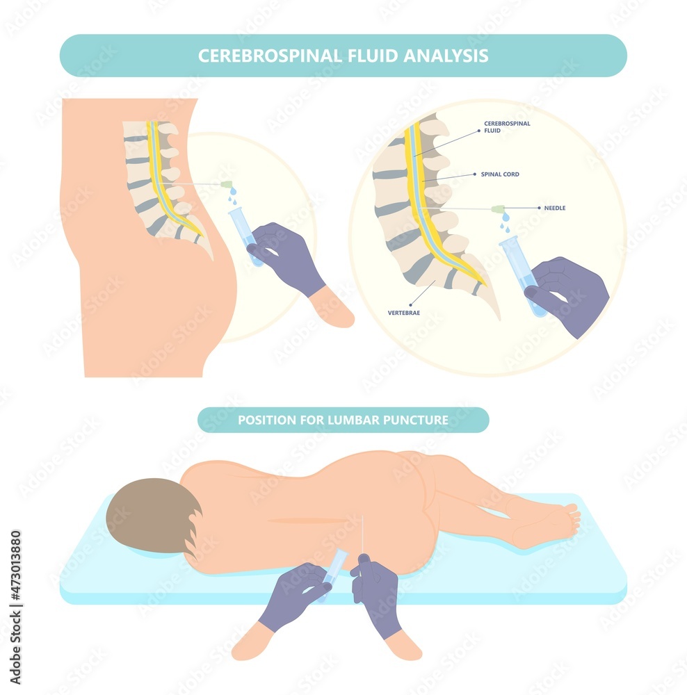 Lumbar puncture for infalmmation Bleeding cancer brain inject ...