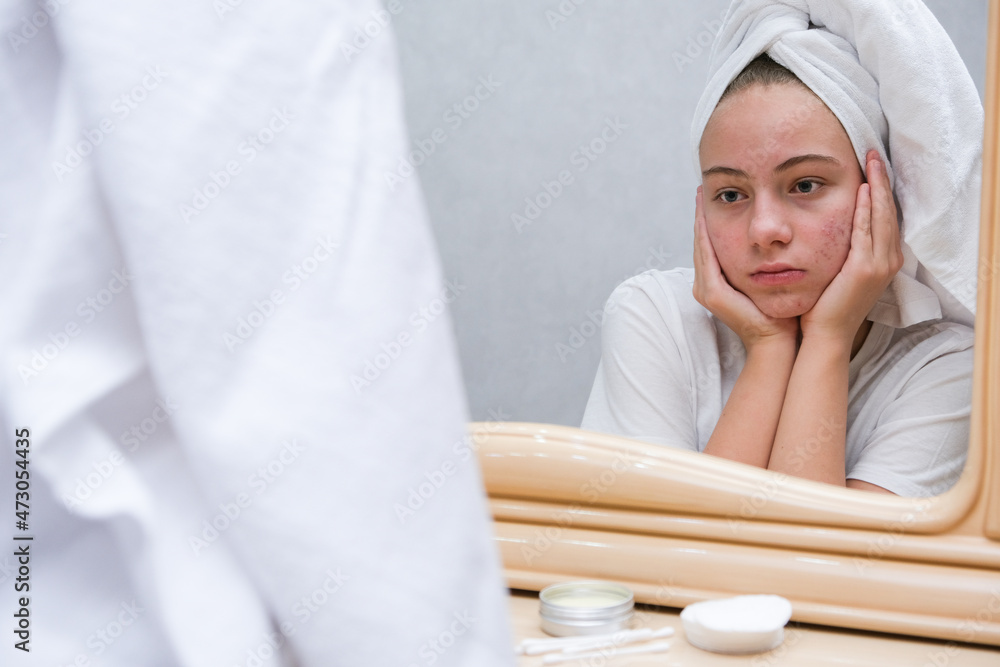 Acne. A sad teenage girl. Problematic skin in adolescents. Stock Photo ...