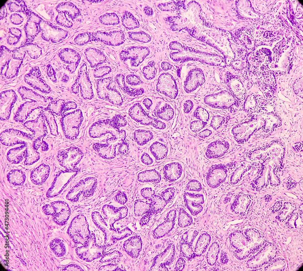 Nodular prostatic hyperplasia. Micrograph show proliferation of fibro ...