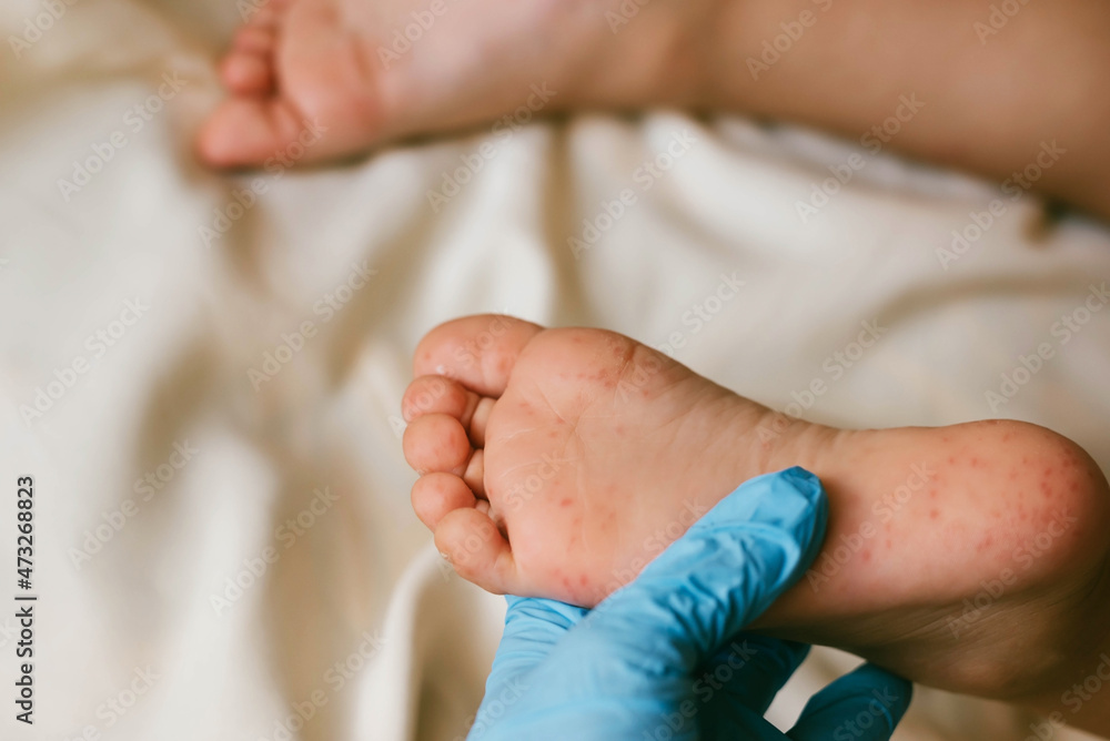 Rash of enterovirus infection picornavirus families on the feet of a 3 ...
