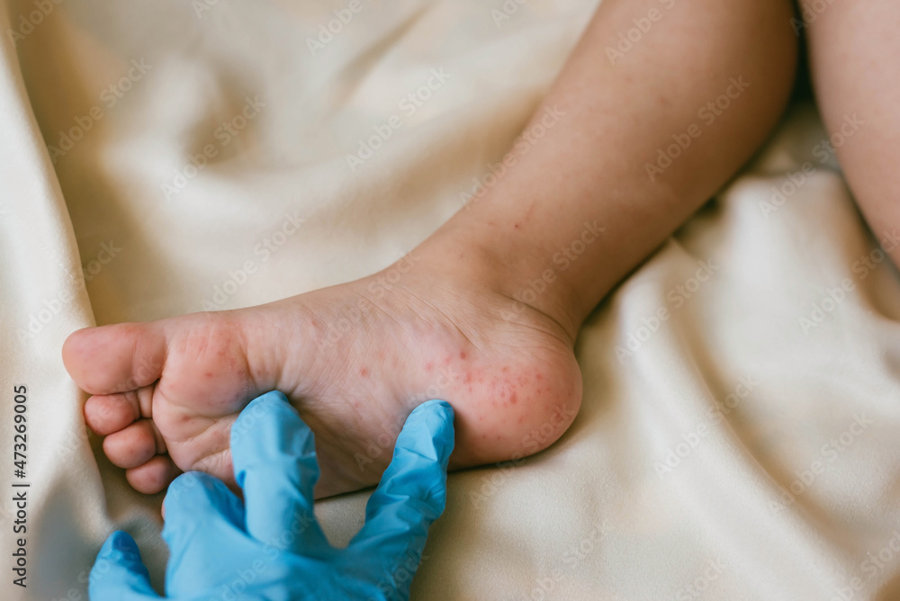 Rash of enterovirus infection picornavirus families on the feet of a 3 ...