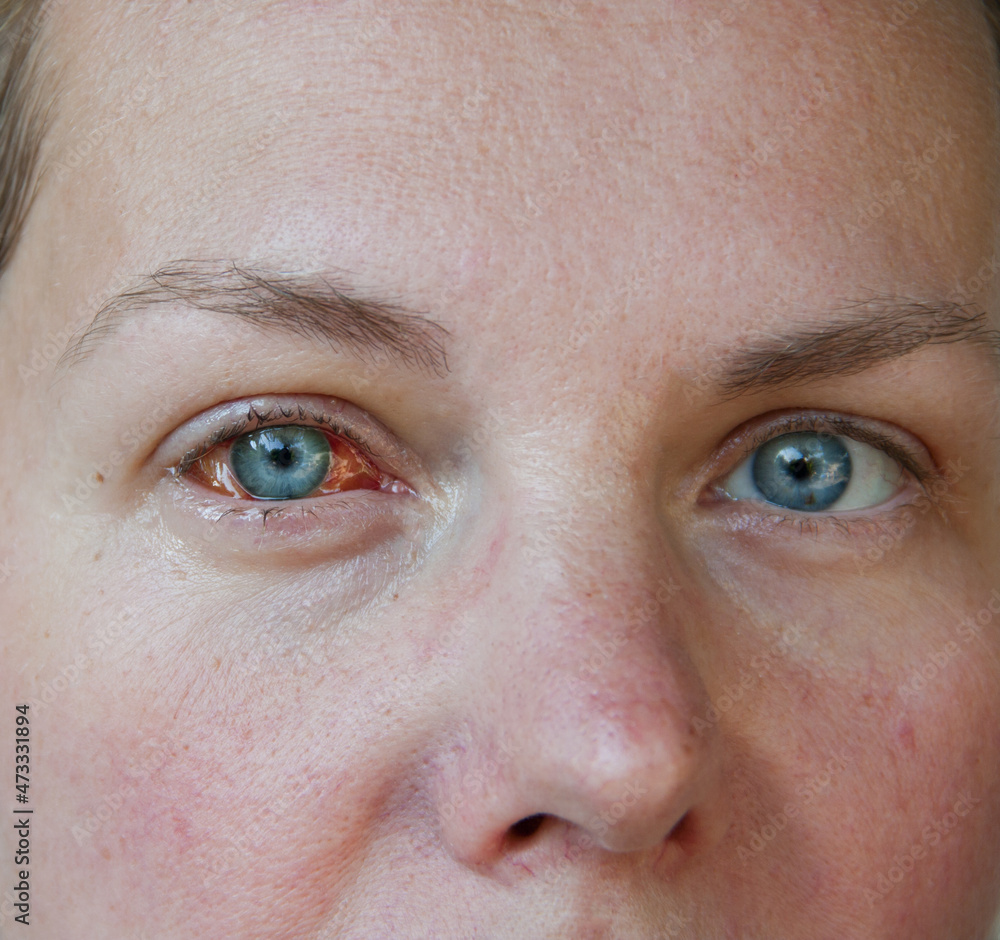 The woman's right eye is sick with keratitis. The fibrous tunic of ...