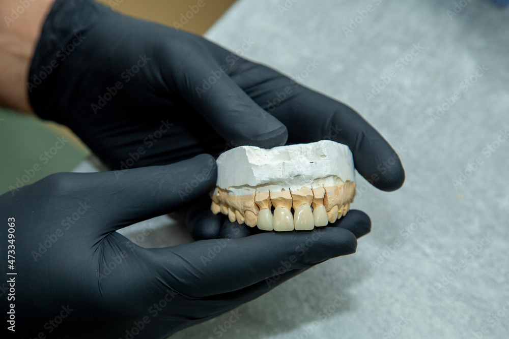doctor working with a layout of teeth. Mold of teeth in the hands of a ...