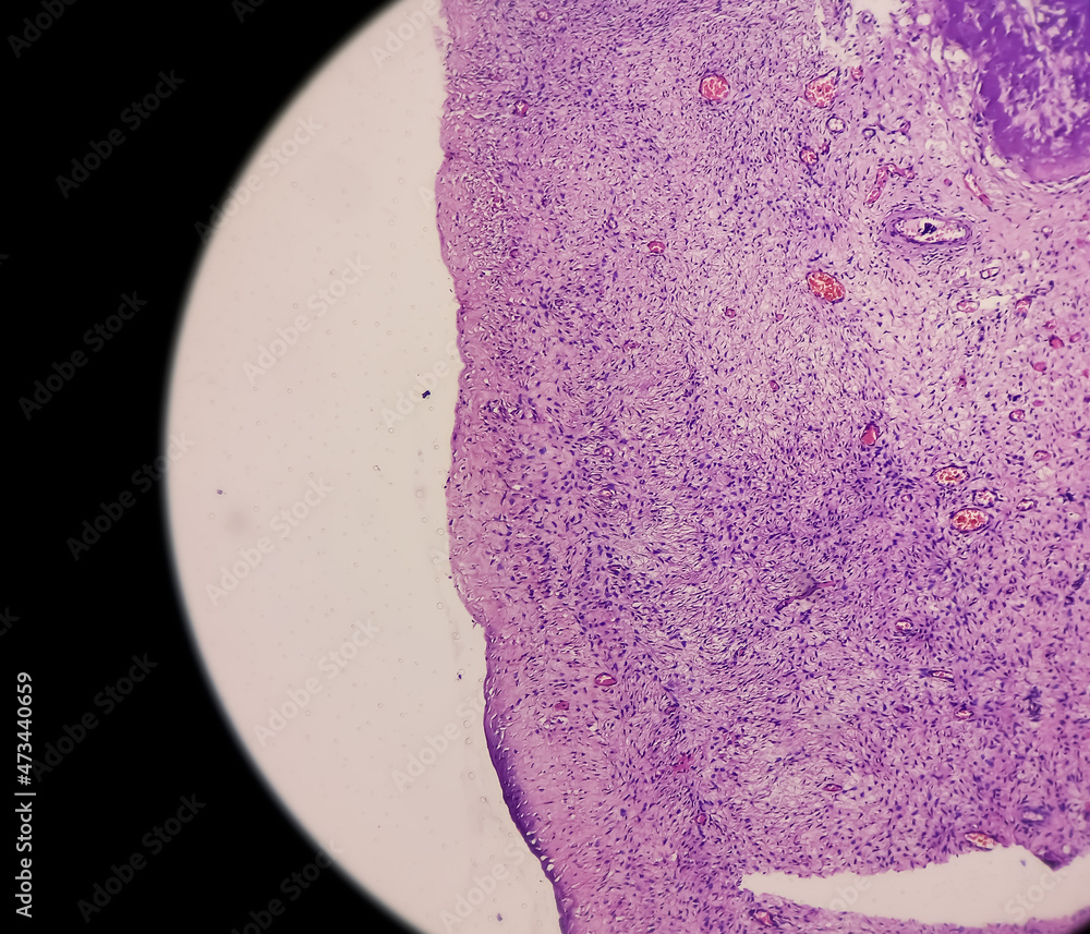 Inflammatory breast lump, Chronic nonspecific mastitis with fibrocystic ...