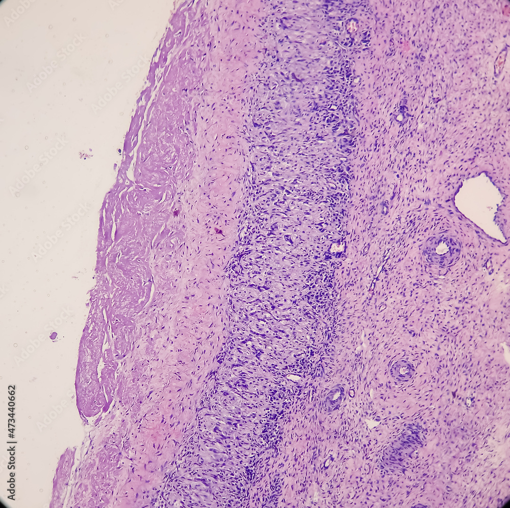 Inflammatory breast lump, Chronic nonspecific mastitis with fibrocystic ...