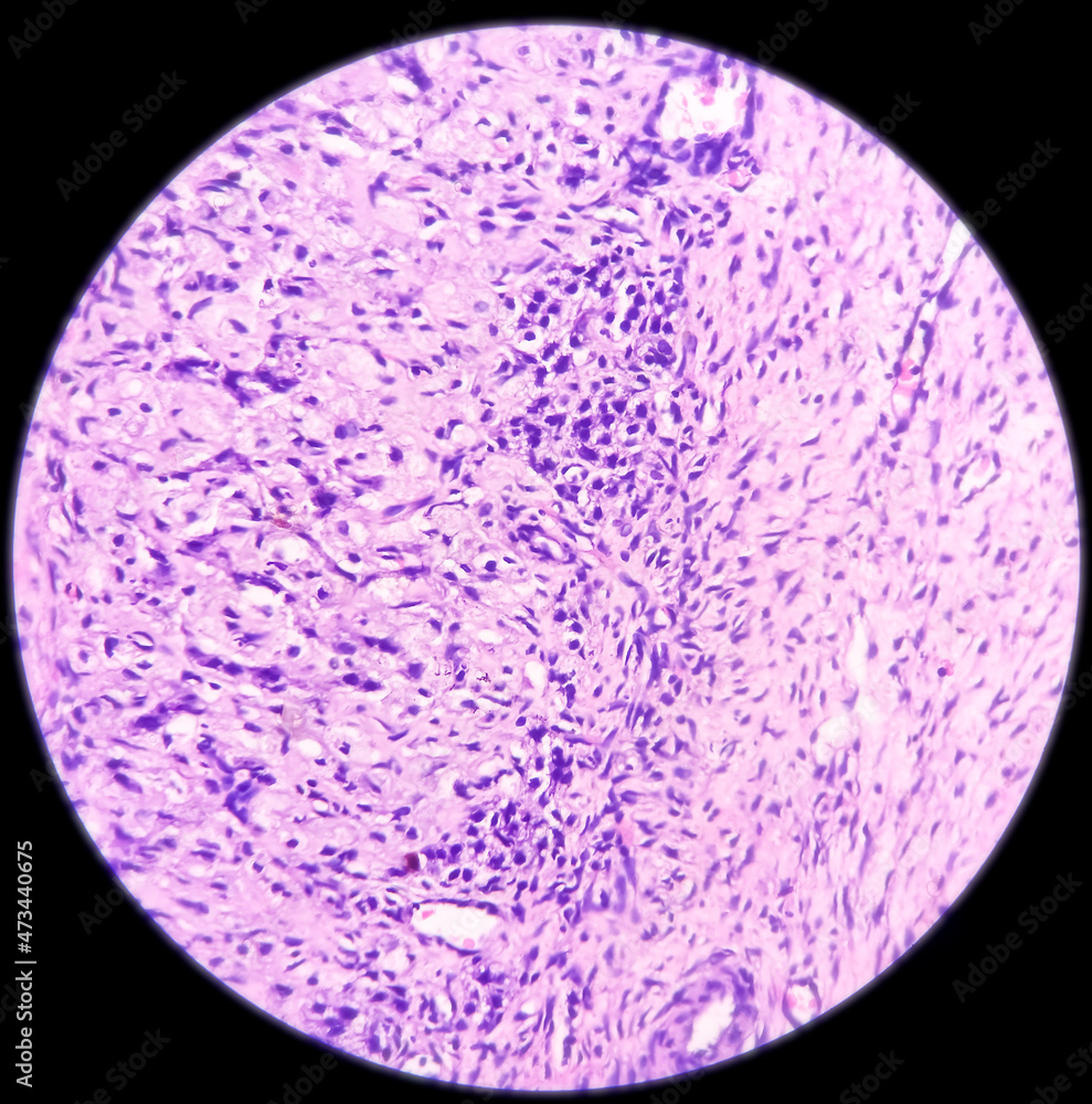 Inflammatory breast lump, Chronic nonspecific mastitis with fibrocystic ...