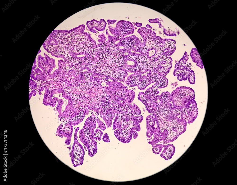 Prostate Cancer Awareness: Photomicrograph (microscopic image) of core ...