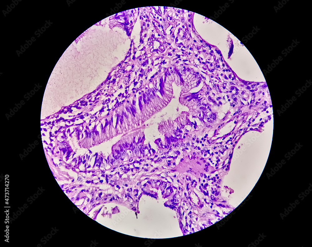 Prostate Cancer Awareness: Photomicrograph (microscopic image) of core ...