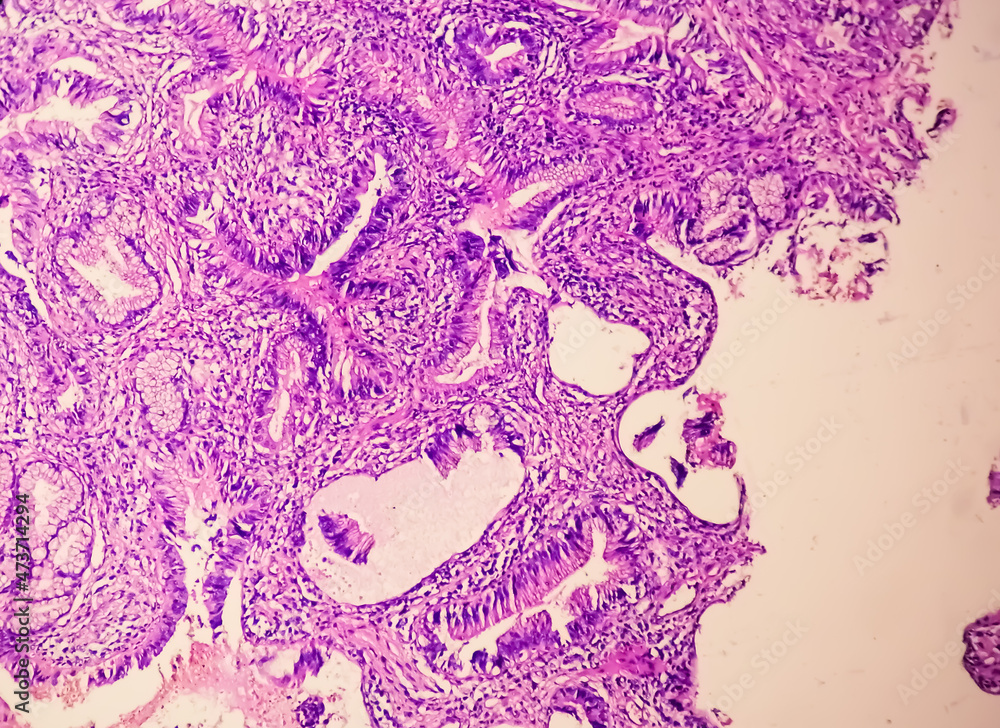 Prostate Cancer Awareness: Photomicrograph (microscopic image) of core ...