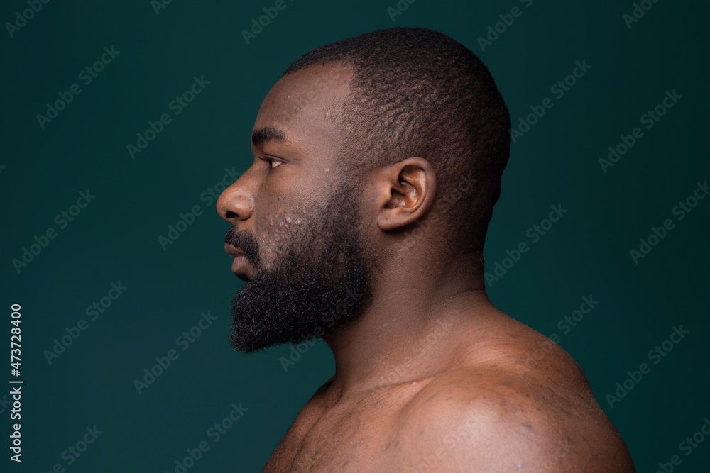 African man with skin problems side profile Stock Photo | Adobe Stock