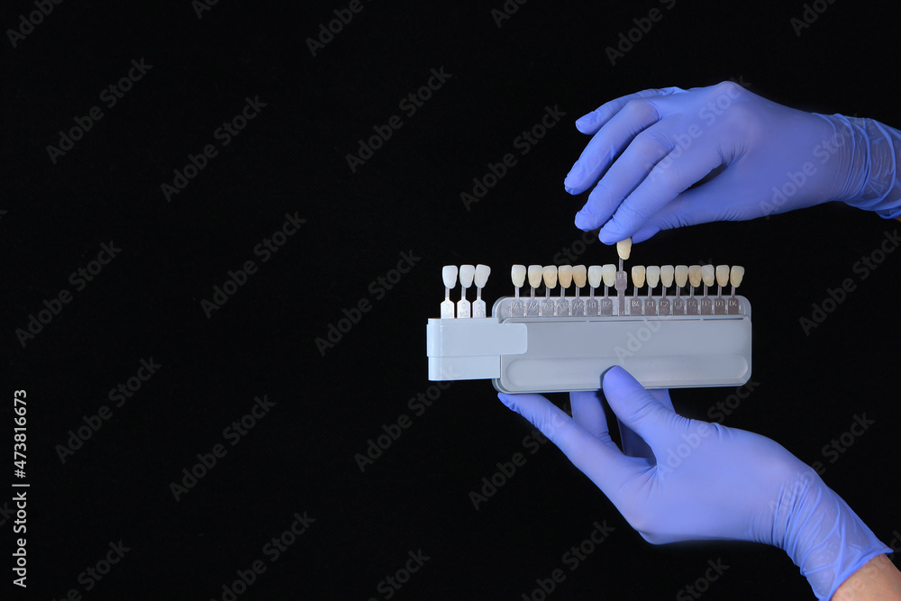 A sample of the color of the teeth to determine the shade of patient's ...