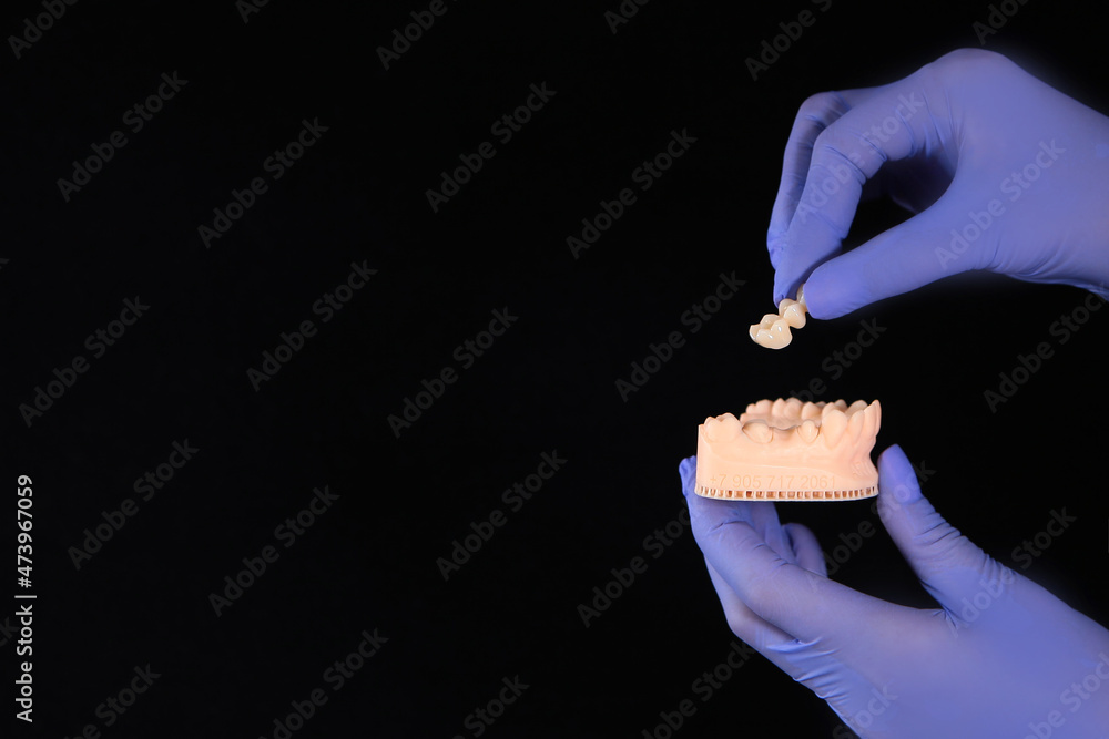 Removable partial denture of teeth. Model of teeth and dental bridges ...