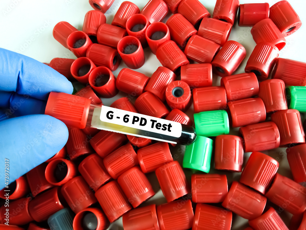Blood sample tube for G6PD(glucose-6-phosphate dehydrogenase) test ...