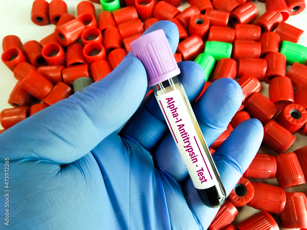 Scientist holds a blood sample tube for Alpha 1 antitrypsin(A1AT) Test ...