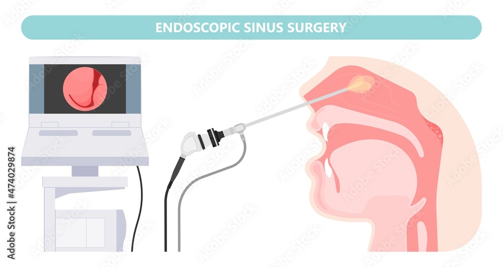 Nasal Endoscopy. Throat back voice box larynx vocal cord pain airway ...