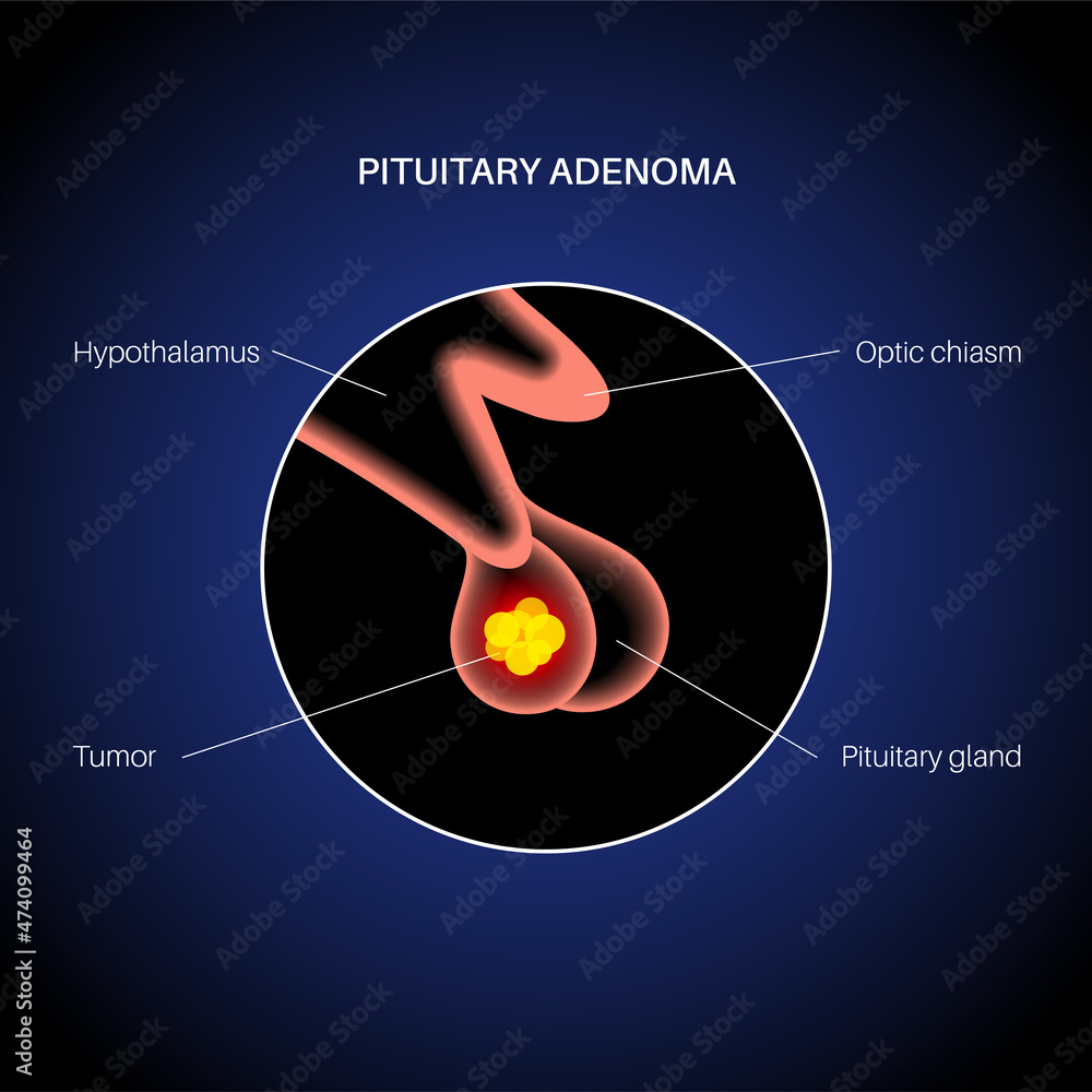 Pituitary adenoma cancer Stock Vector | Adobe Stock