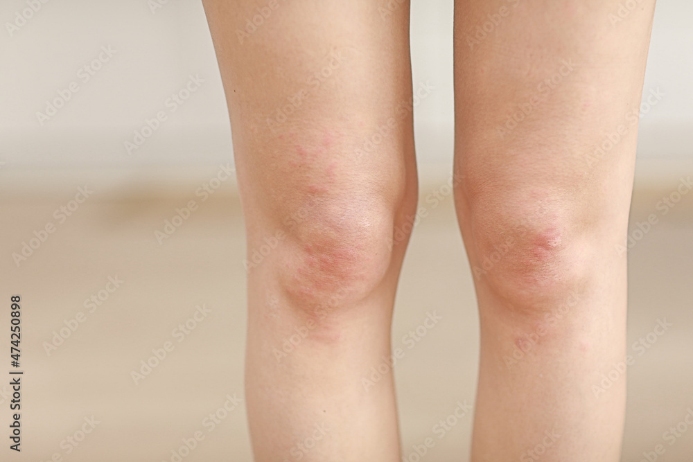 skin allergies, legs skin women. Closeup of red pustules on a knee, an ...