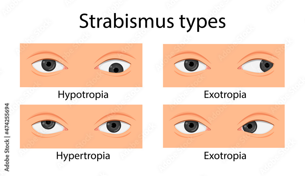 Poster Types of strabismus – Wall Art | UkPosters