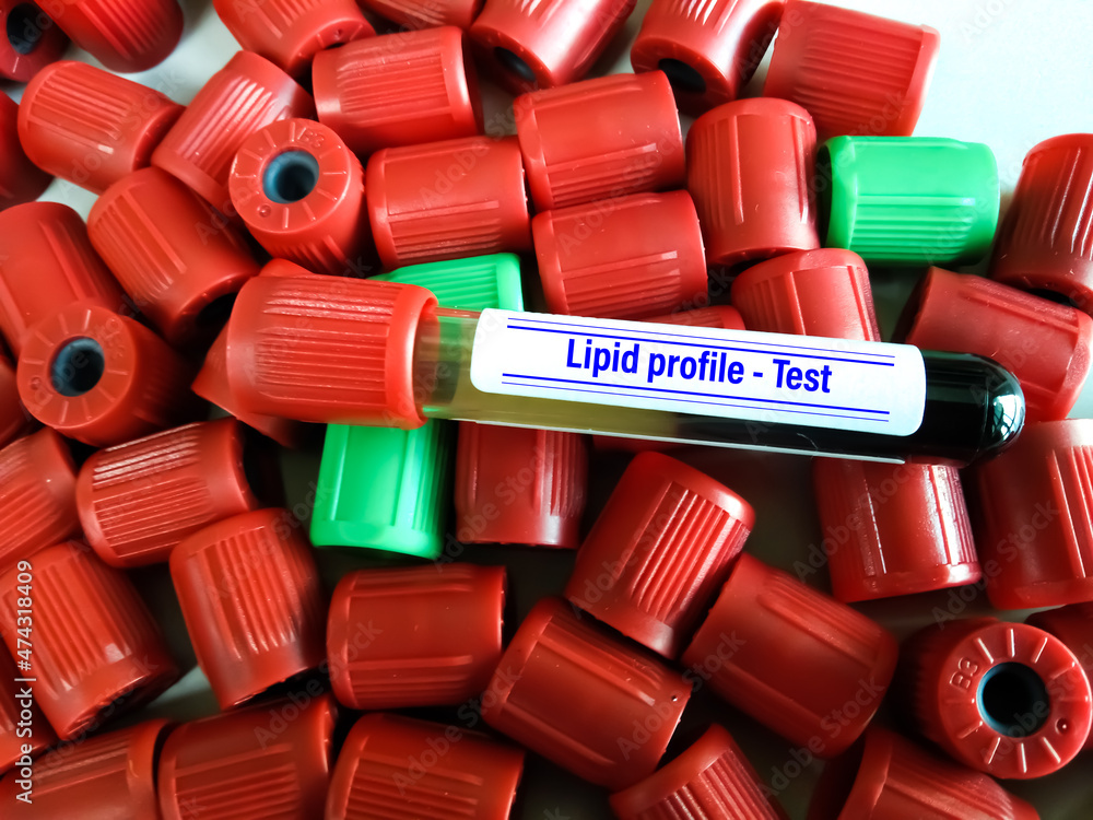 Blood sample for Lipid profile, LDH and serum cholesterol testing Stock ...