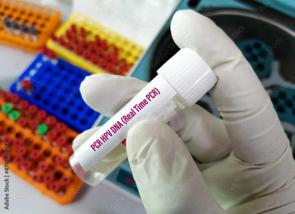 Scientist holding sample container Cervical Fluid sample for PCR HPV ...