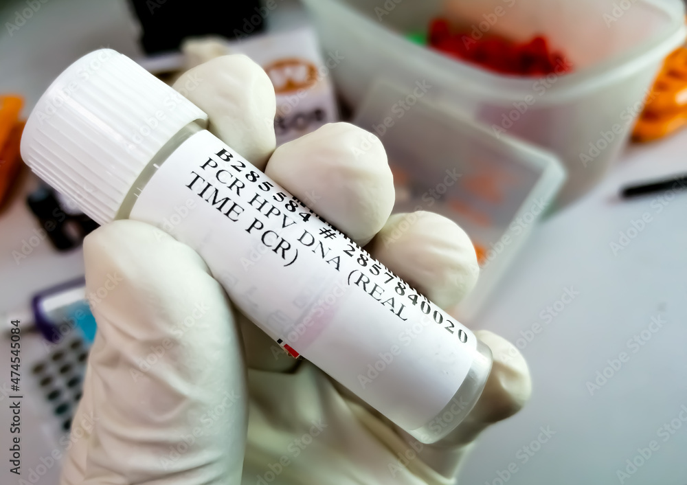 Scientist holding sample container Cervical Fluid sample for PCR HPV ...