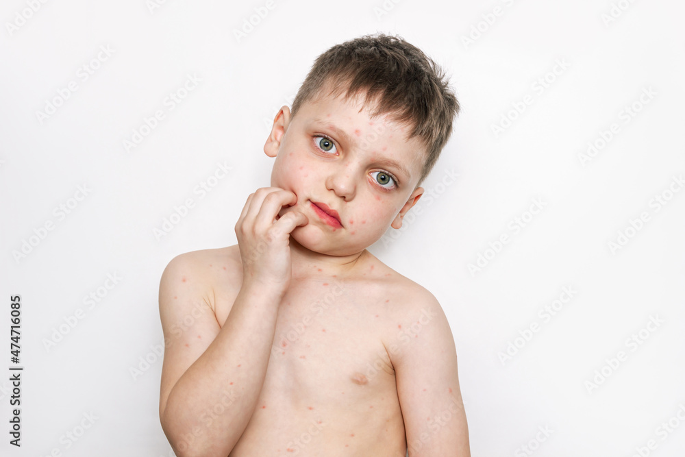 A portrait of a child with a red rash on his body scratching his face ...