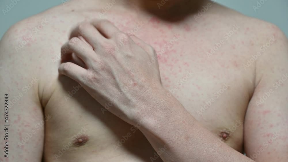 Video Stock Dermatitis viral disease of young adult asian body standing ...