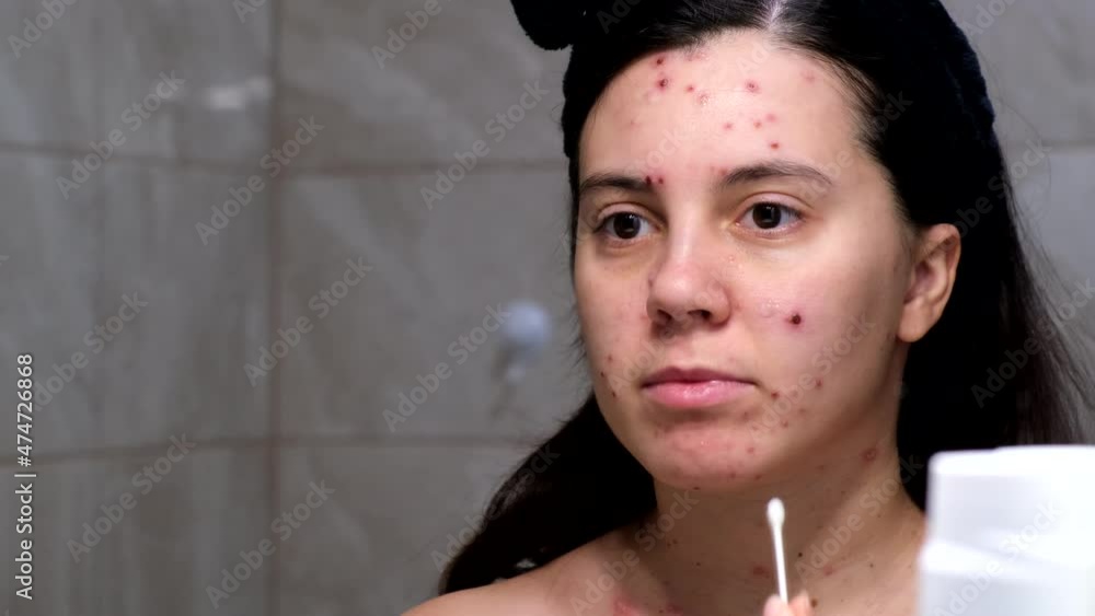 woman face covered with red acne chickenpox disease vídeo de Stock ...