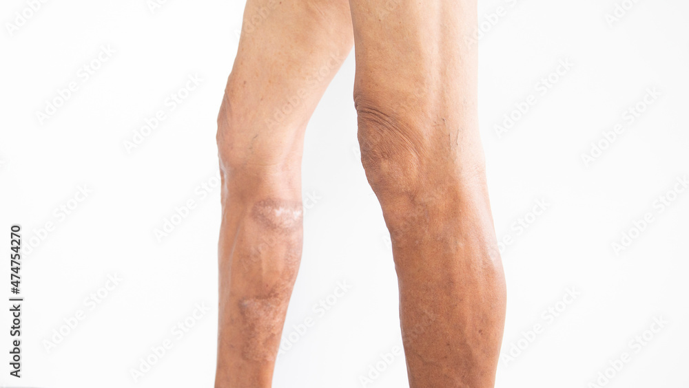 Muscles, organ of the leg and knee of the elderly Stock Photo | Adobe Stock