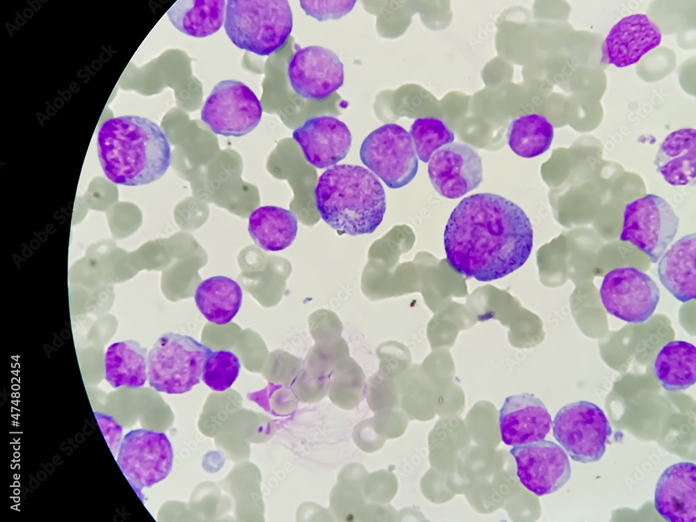 Photomicrograph of Acute Myeloblastic Leukemia (AML), a cancer of white ...