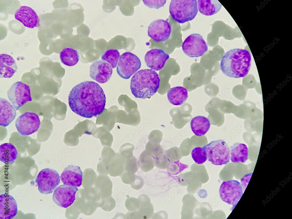Acute myeloid leukemia (AML) is a type of blood cancer. Microscopic ...